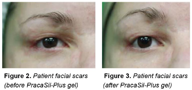 PracaSil-Plus for Scars & Burns | Fallowfield Pharmasave Pharmacy